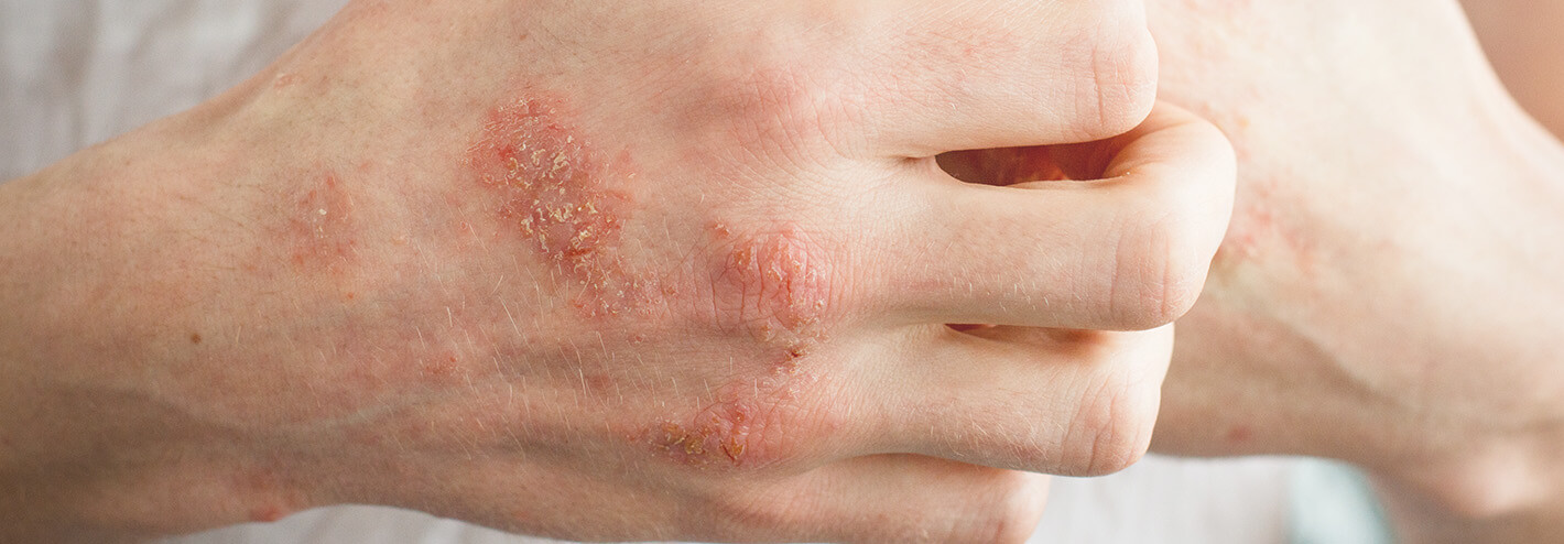 What is atopic dermatitis?